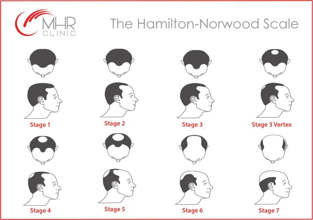 Review: Finasteride vs. Saw Palmetto in DHT Inhibition and Hair Loss ...